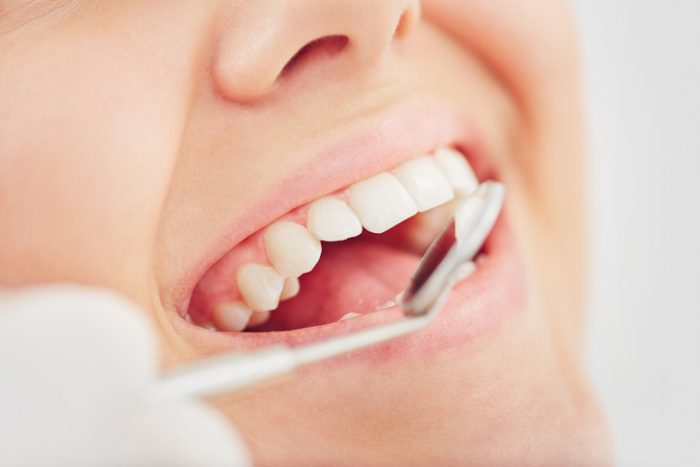 The Benefits of Scale and Polish | Gentle Dental Care